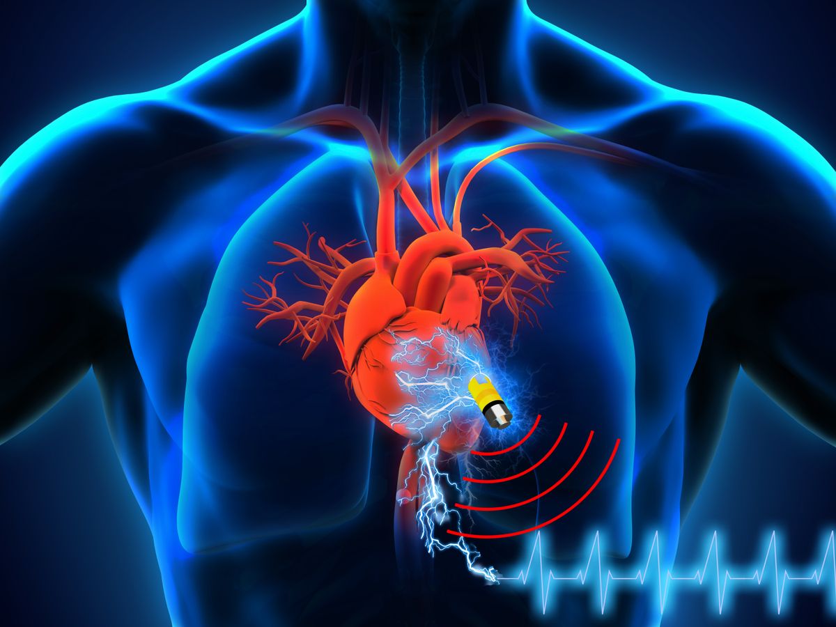 Over 8,600 Security Flaws Found in Pacemaker Systems Over 8,600 Security Flaws Found in Pacemaker Systems